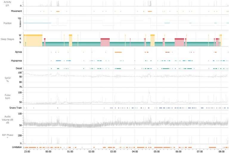 Nox T3s - Apex Medical Ltd Auckland New Zealand