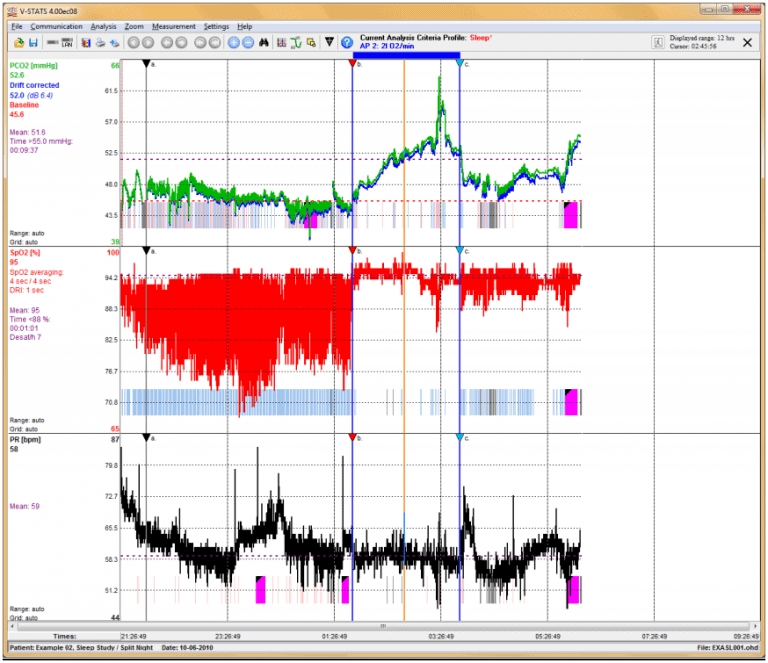 SenTec V-Sign System | Apex Medical Ltd New Zealand